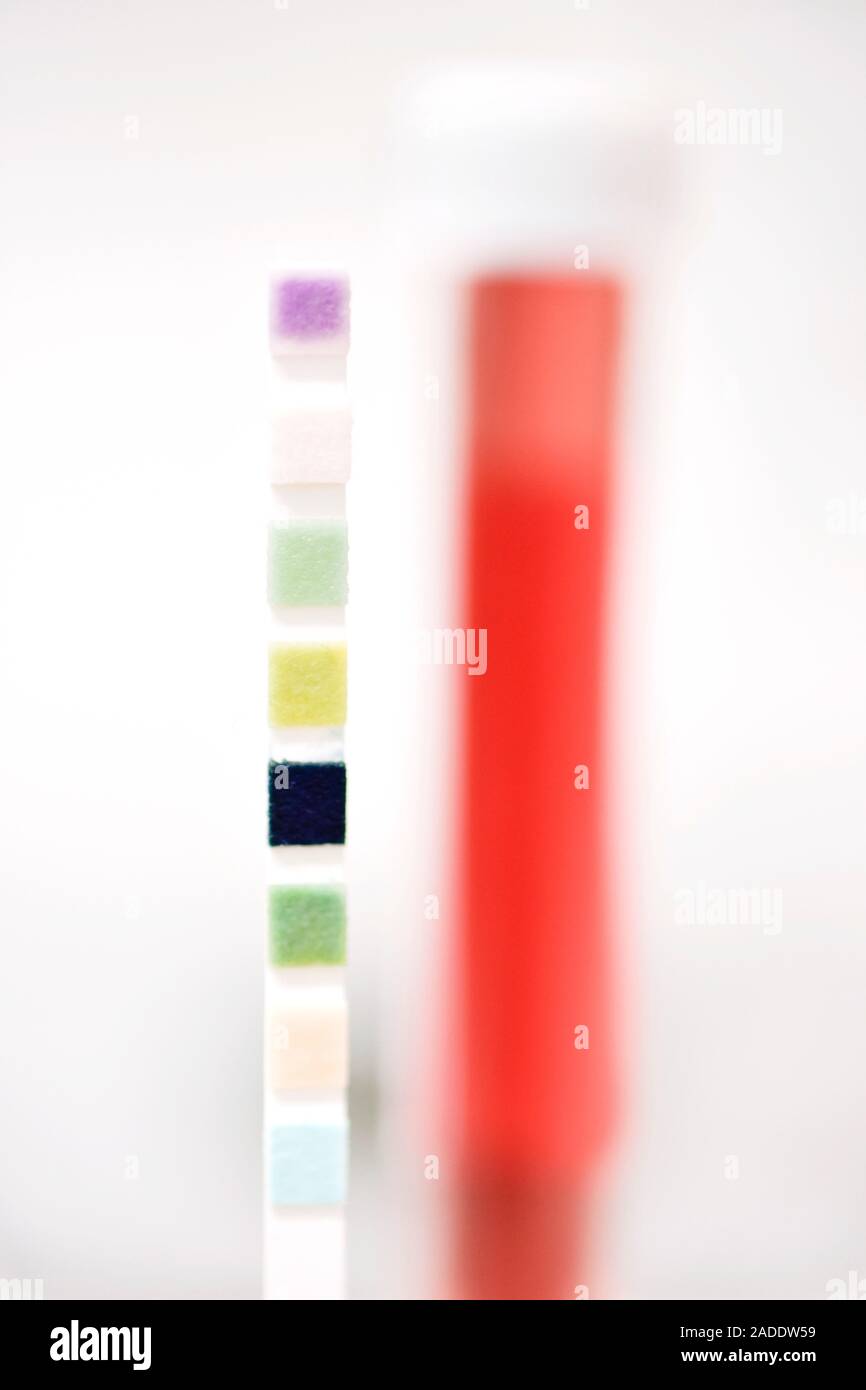 Urine test for cystitis. Urine sample being tested with a kit used to ...