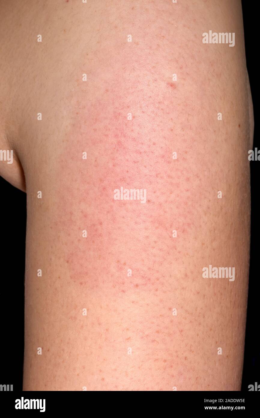 Meningitis vaccine reaction. Close-up of a rash on a 20-year-old female ...
