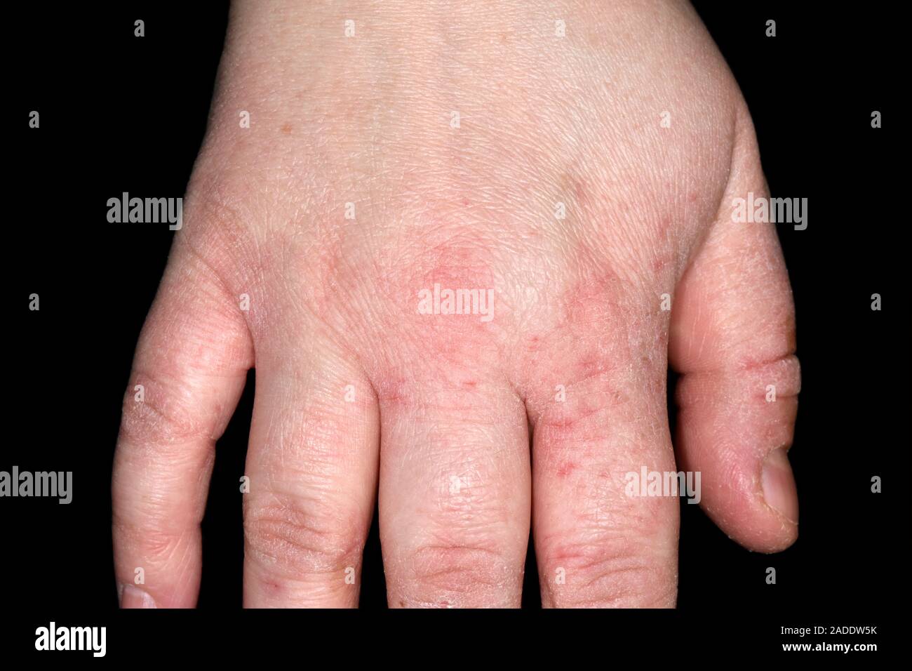 Eczema on the hand. Close-up of the hand of a 29-year-old female ...