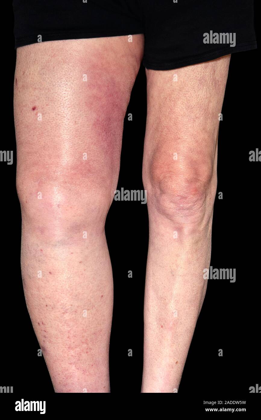 DVT in brain cancer. Close-up of swelling of the right leg (left) of a ...