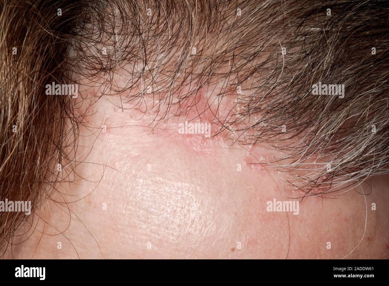 Lichen planopilaris. Close-up of the scalp of a 67-year-old female ...