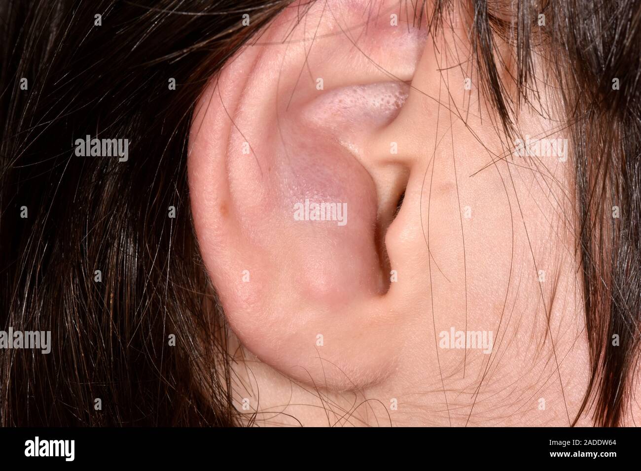 Ear seroma in cerebral palsy. Close-up of the swollen ear of a 16-year ...