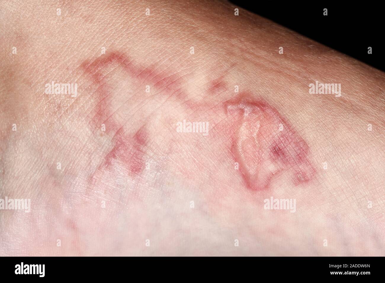 Cutaneous larva migrans infection. Close-up of the skin of a 29-year ...
