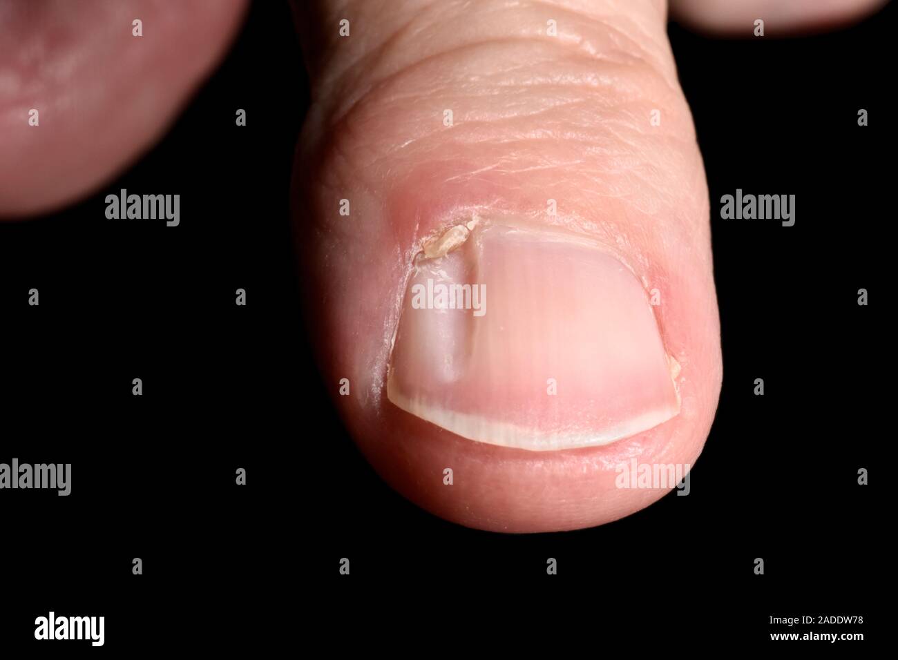 Grooved nail with mucous cyst. Close-up of a groove in the finger nail ...