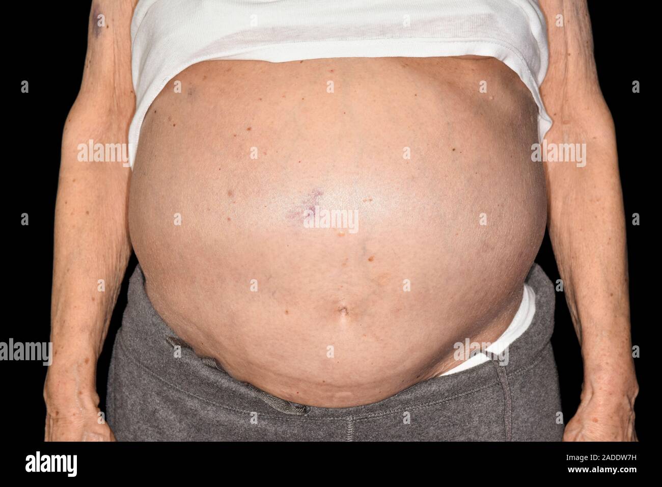 Liver disease in secondary skin cancer. Close-up of the distended ...