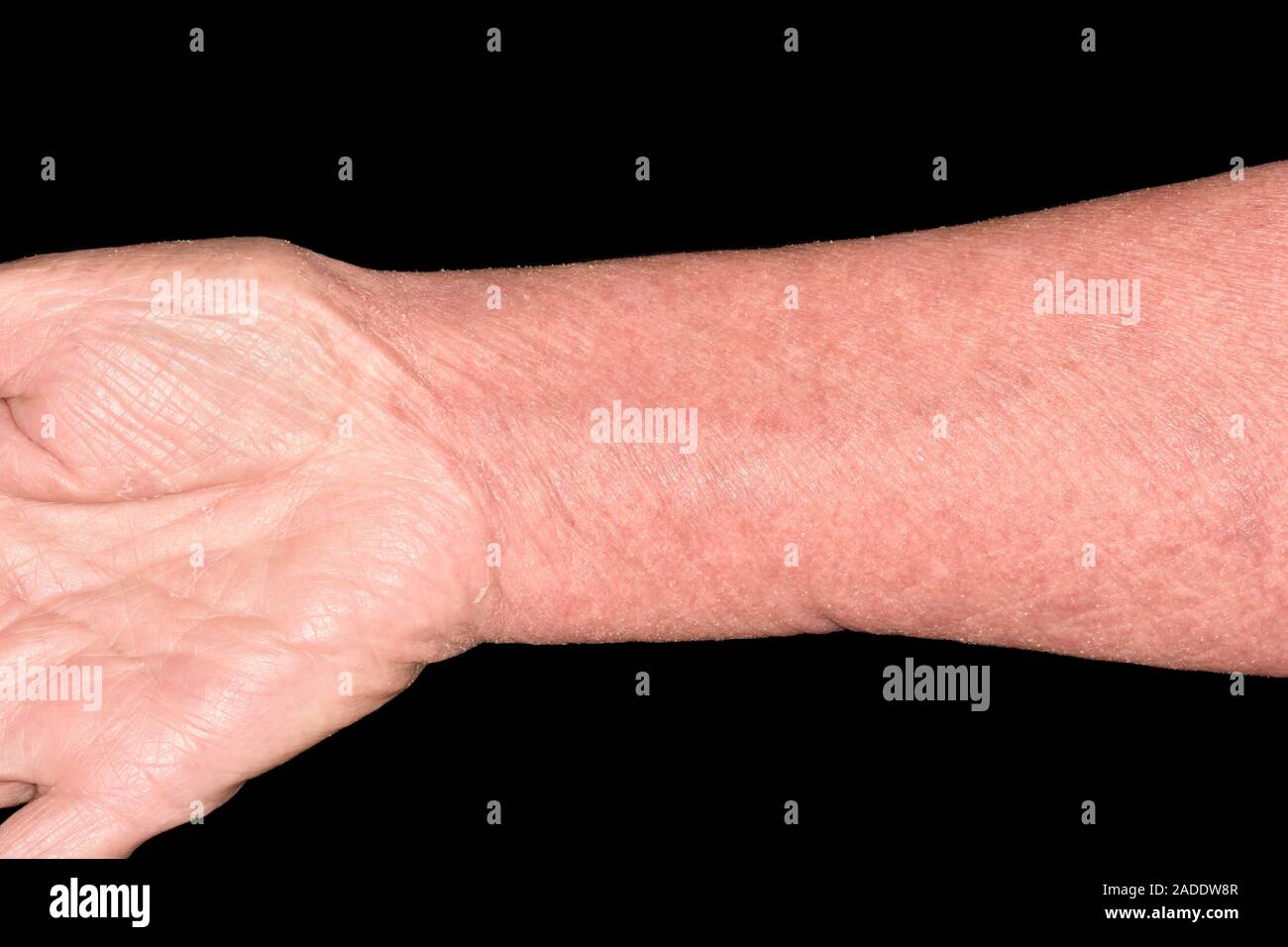 Erythrodermic psoriasis. Close-up of red lesions on the skin of an 85 ...