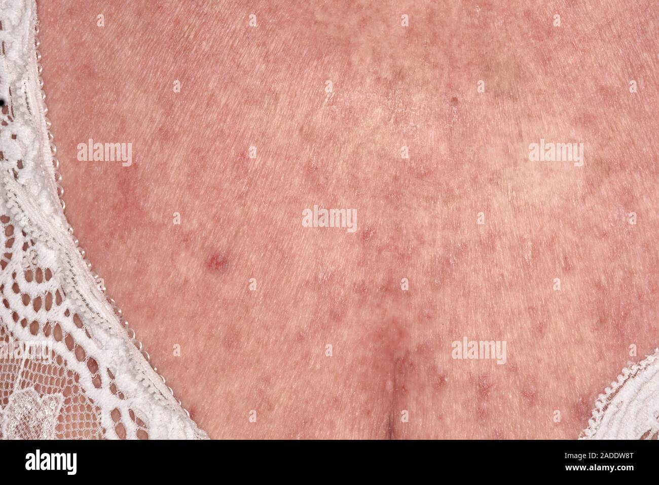 Erythrodermic psoriasis. Close-up of red lesions on the skin of an 85 ...