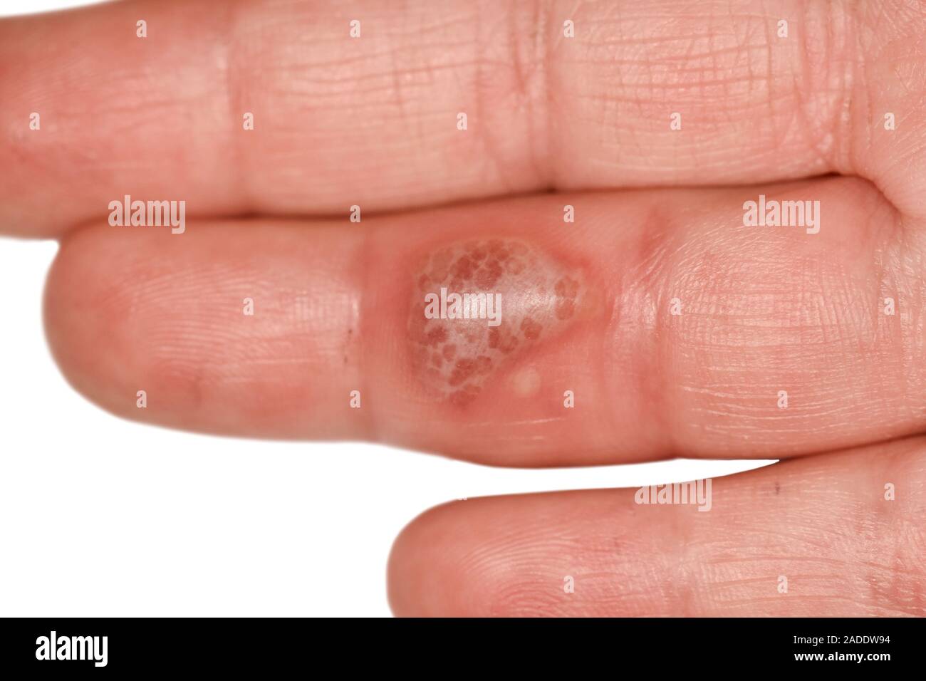 Herpes simplex infection. Close-up of a sore on the hand of a 7-year ...