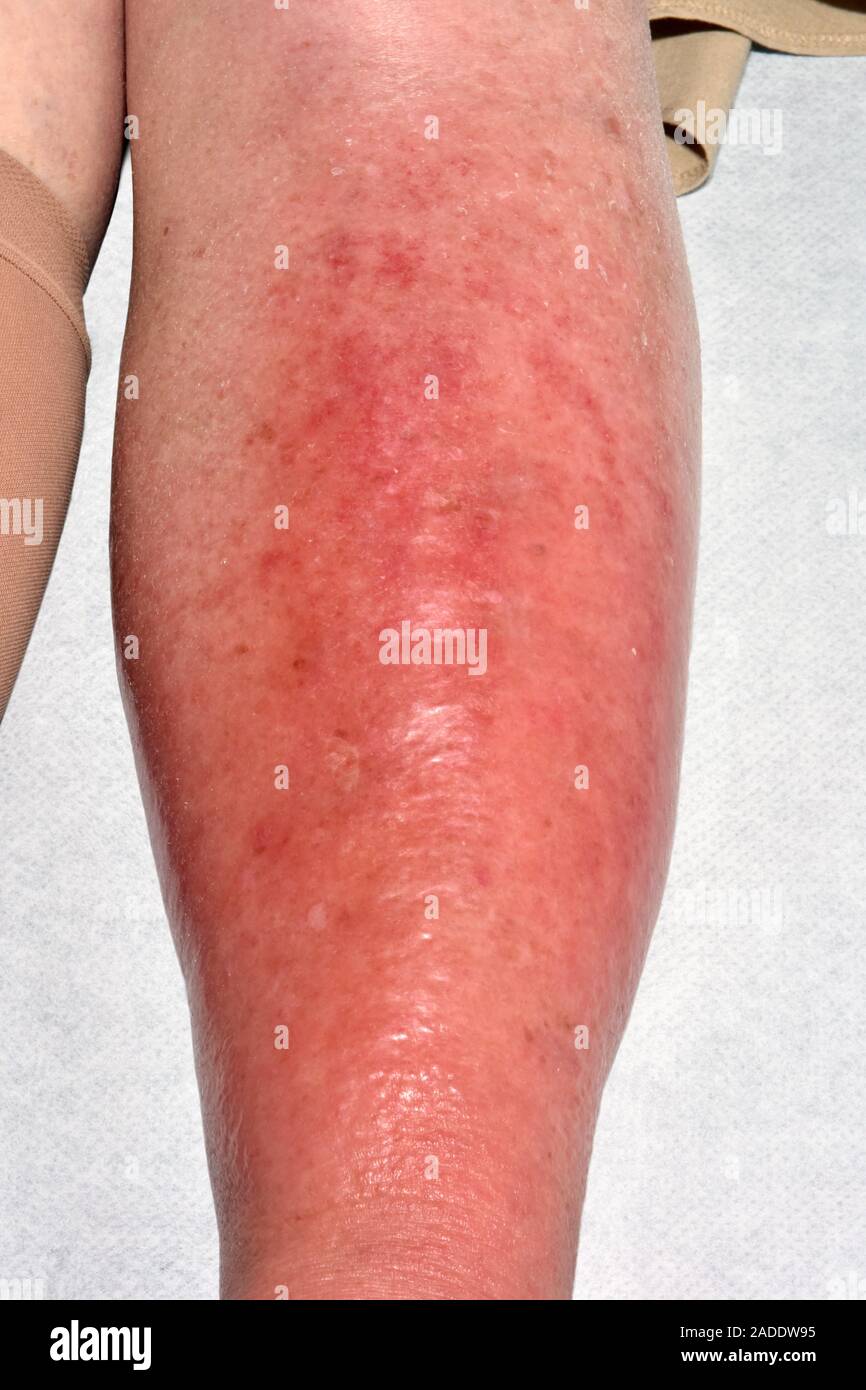 Cellulitis of the leg. Close-up of the leg of an 88-year-old woman with ...