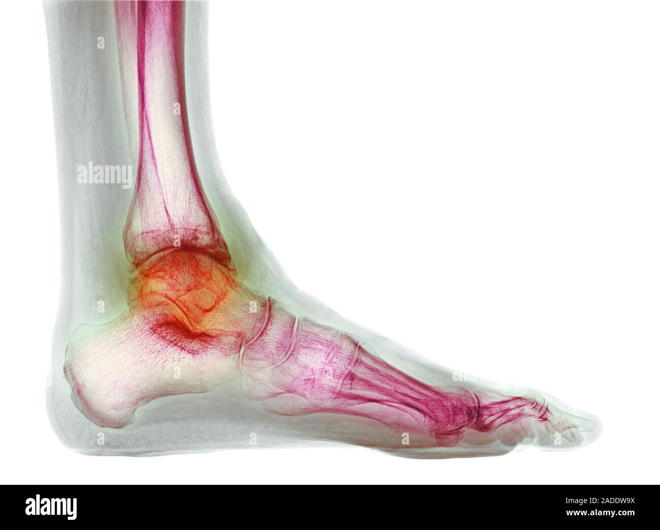 Osteoarthritis of the ankle. Coloured X-ray of the ankle of a 73-year ...