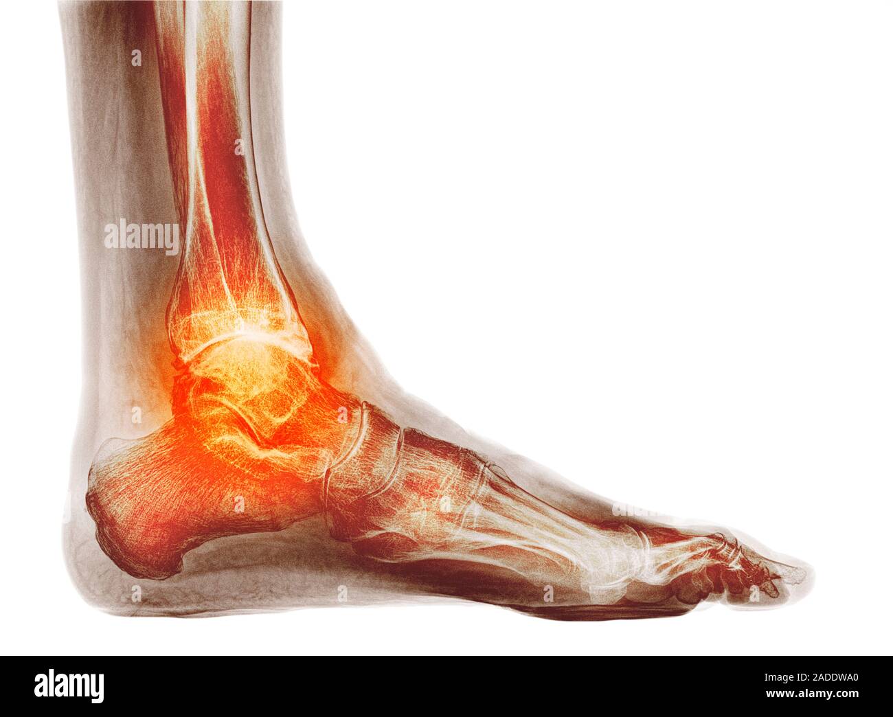 Osteoarthritis of the ankle. Coloured X-ray of the ankle of a 73-year ...