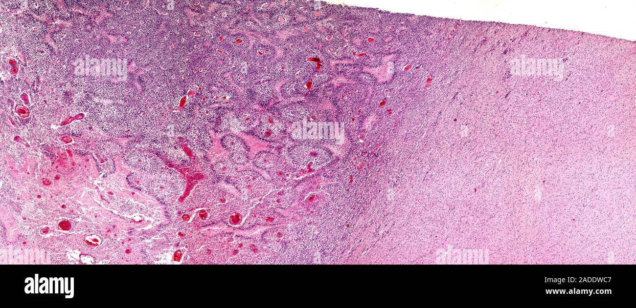 Glioblastoma multiforme (GBM), light micrograph. GBM, also called ...