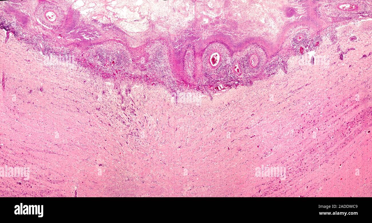 Tuberculosis meningitis, light micrograph. Tuberculosis (TB) meningitis ...