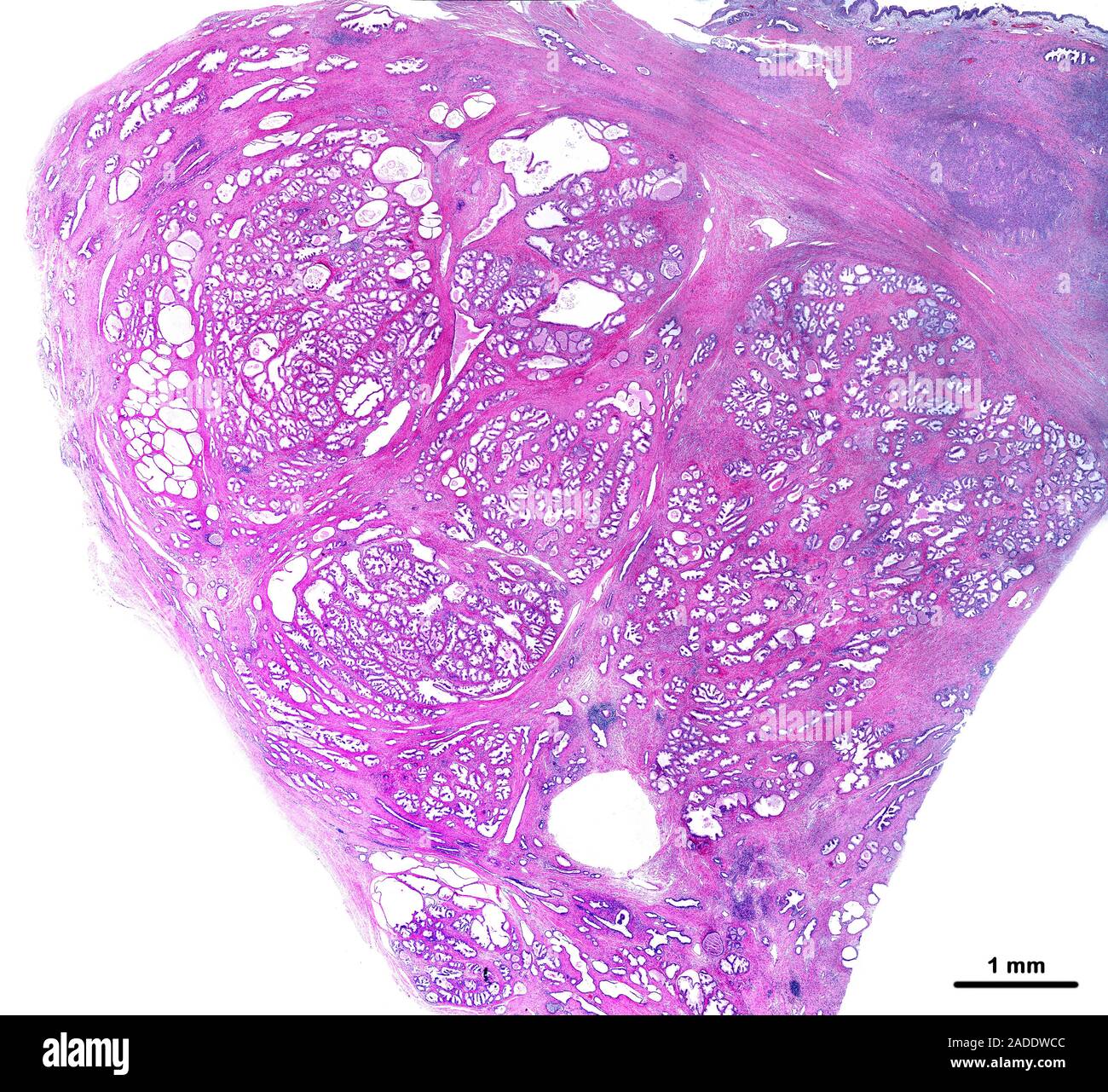 Benign prostatic hyperplasia (BPH), light micrograph. BPH, also called ...