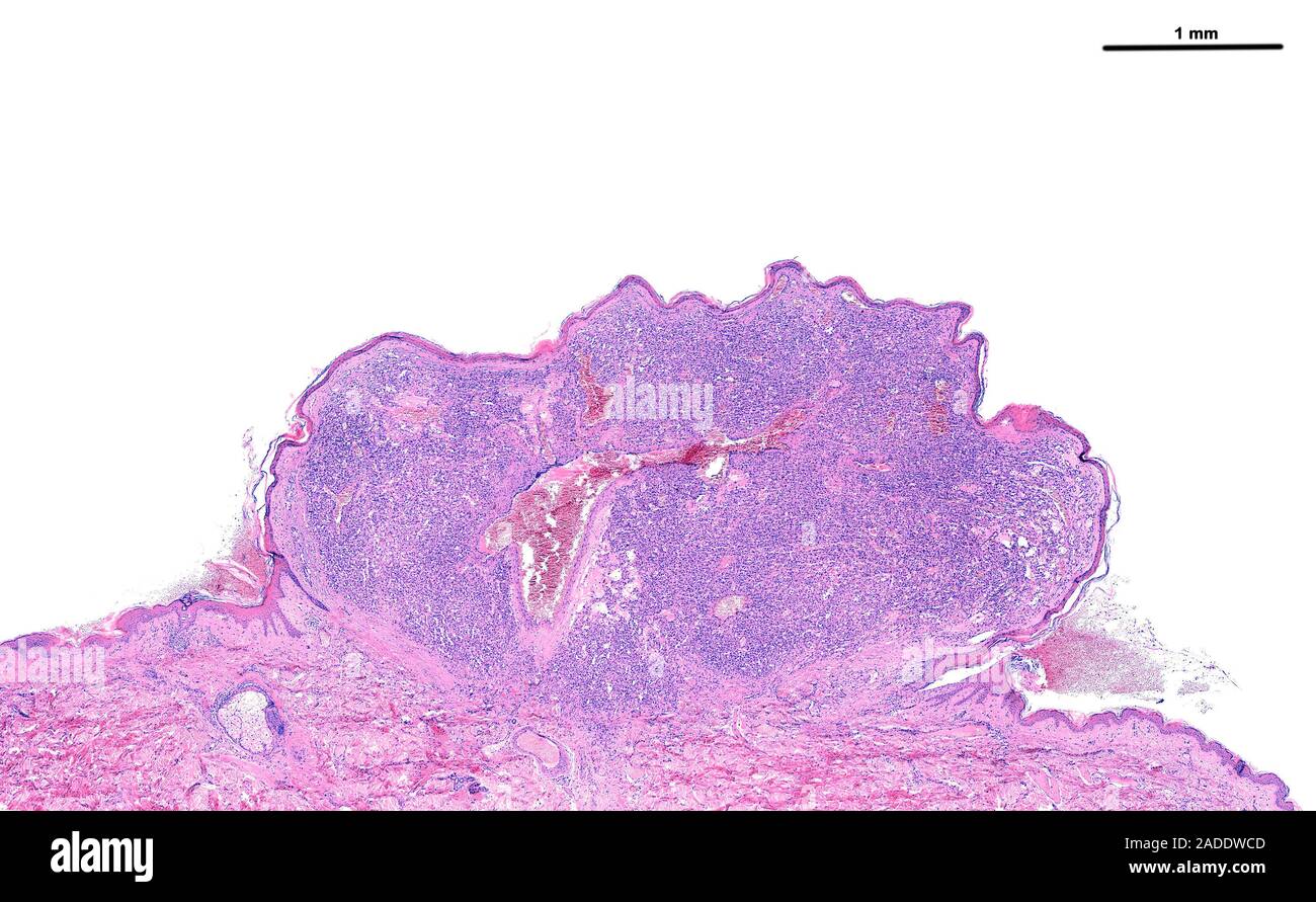 Pyogenic granuloma, light micrograph. Pyogenic granuloma is a ...
