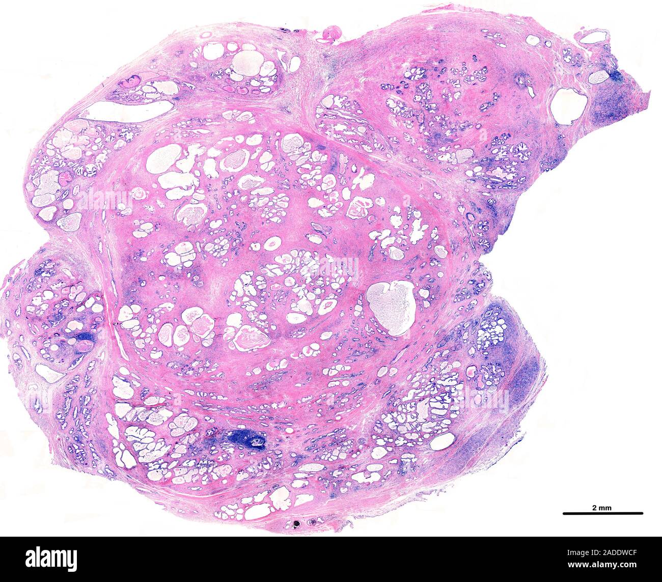 Benign prostatic hyperplasia (BPH), light micrograph. BPH, also called ...