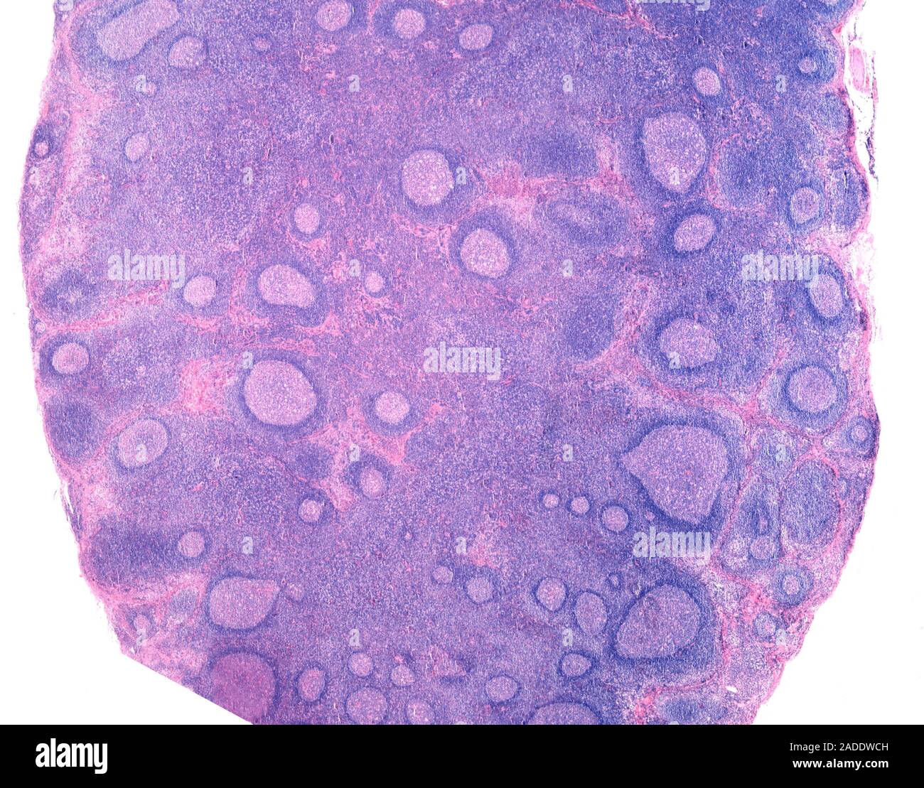 Chronic lymphadenitis, light micrograph. Chronic lymphadenitis is an ...