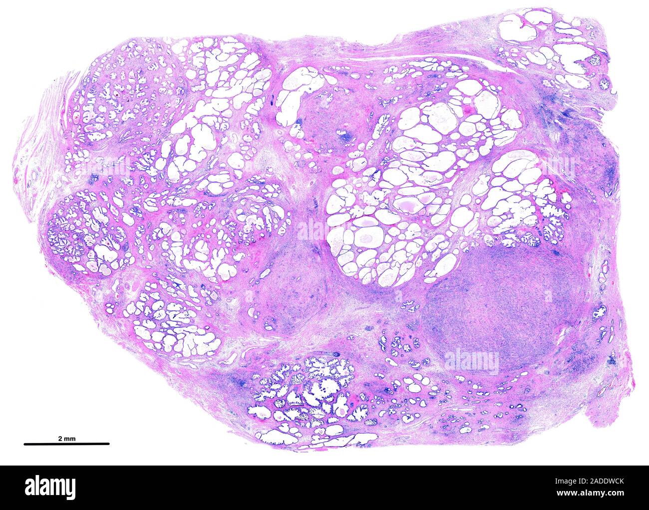 Benign prostatic hyperplasia (BPH), light micrograph. BPH, also called ...