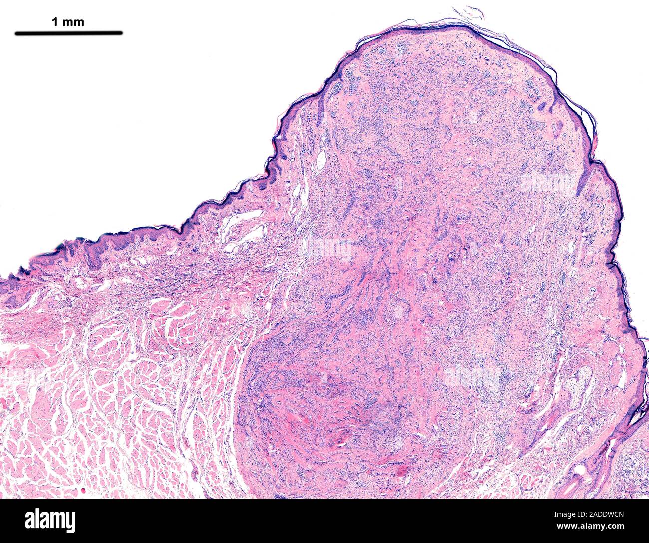 Melanocytic nevus (mole) on lip, light micrograph. Melanocytic nevi are ...