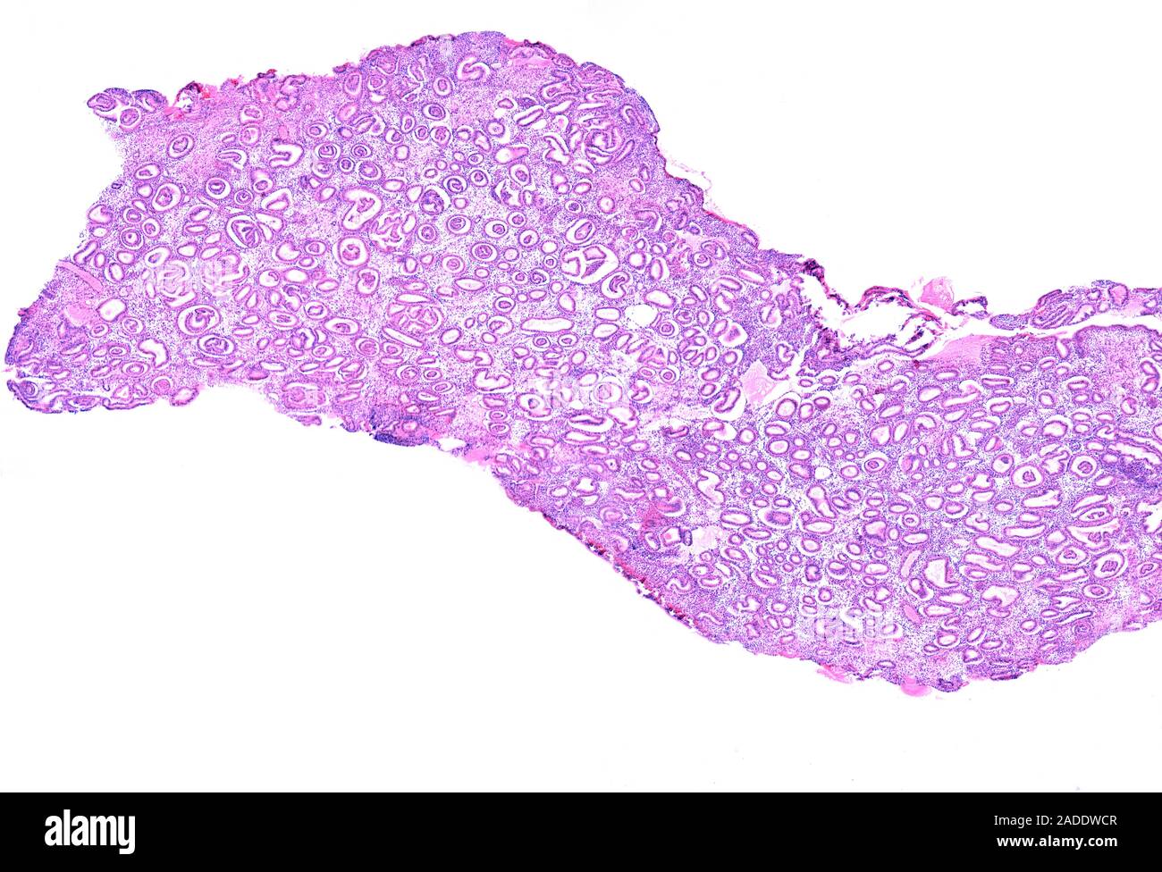 Endometrial hyperplasia, light micrograph. Complex endometrial ...