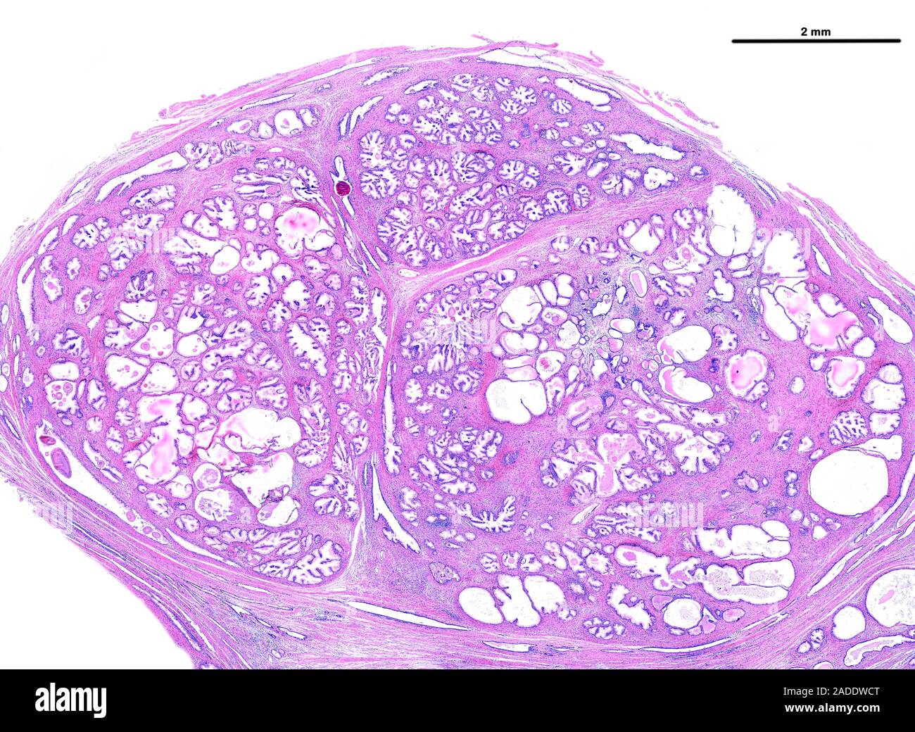 Benign Prostatic Hyperplasia Bph Light Micrograph Bph Also Called