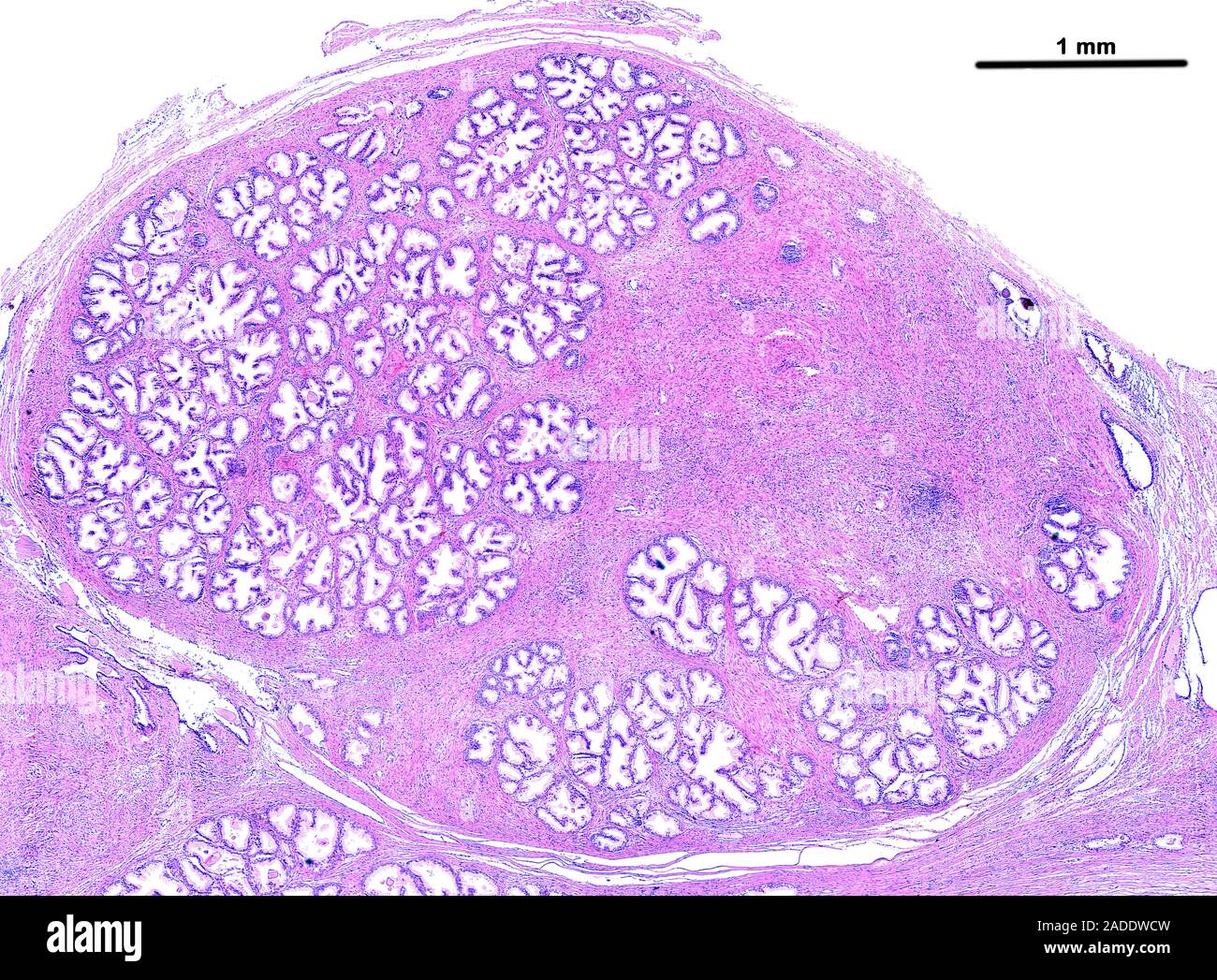 Benign Prostatic Hyperplasia Bph Light Micrograph Bph Also Called