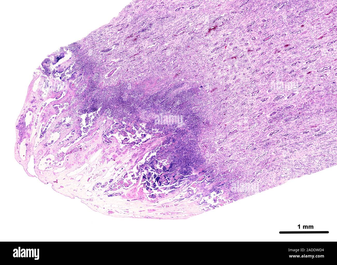 Coagulative Necrosis Kidney