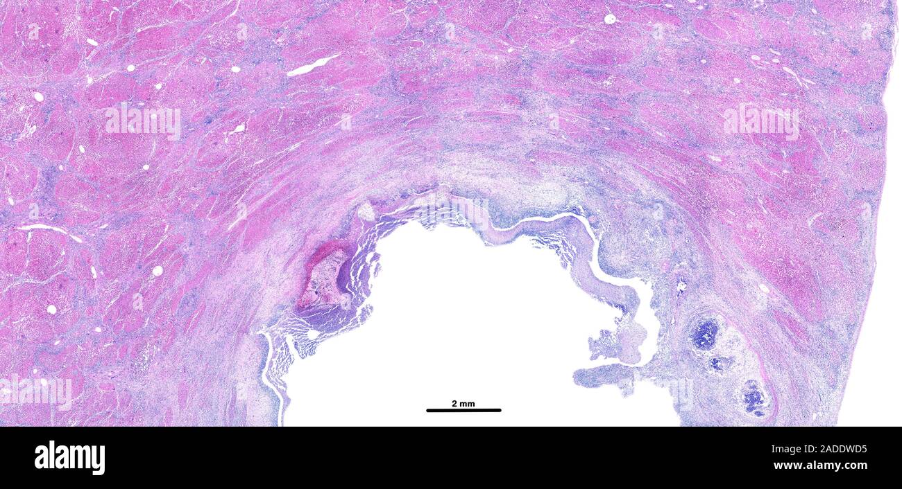 Pyogenic abscess of the liver, light micrograph. A pyogenic liver ...