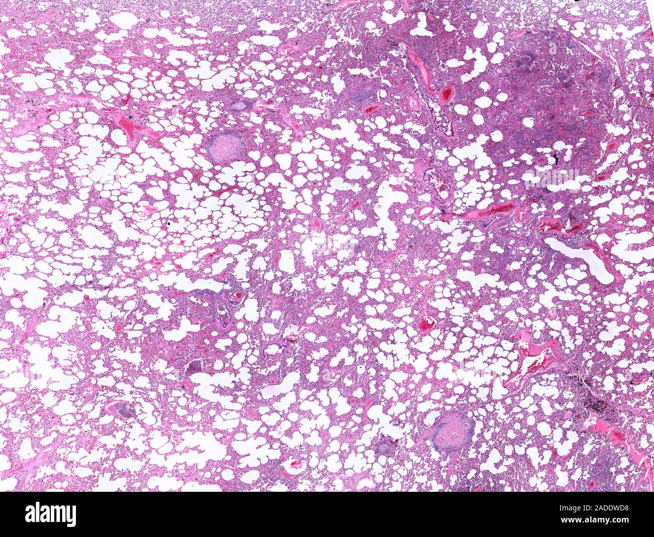 Light micrograph of a human lung in a case of miliary tuberculosis ...