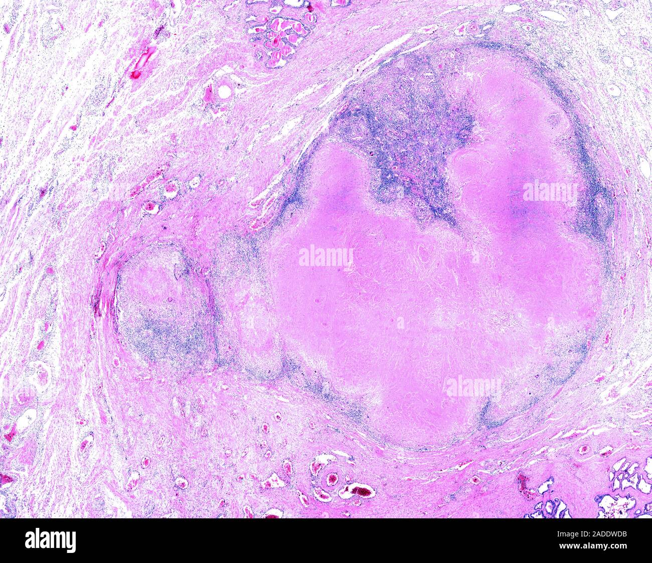 Caseous Necrosis In Tb