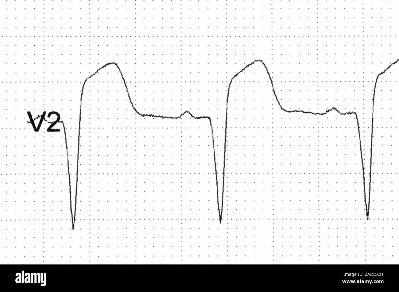 ECG trace for a heart attack. Output for electrode V2 for an ...