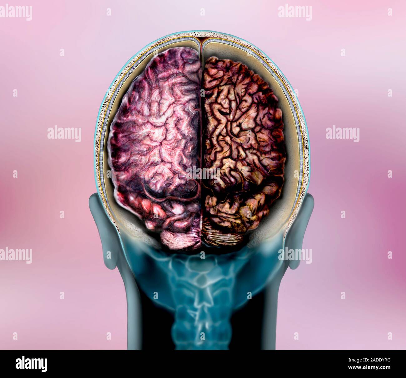 Brain in Alzheimer's disease. Cutaway computer illustration of a ...
