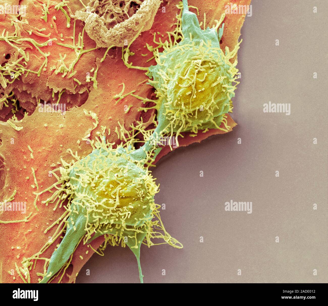 Natural killer (NK) cells interacting with hepatoma cell (HepG2 ...