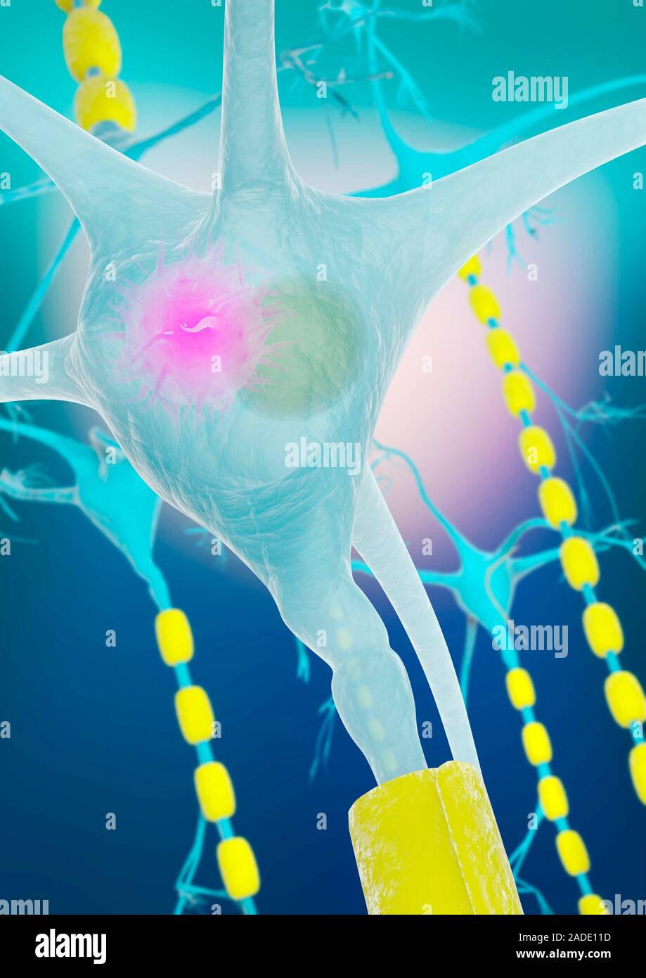 Lewy body in neuron in Parkinson's disease, illustration. Lewy bodies ...