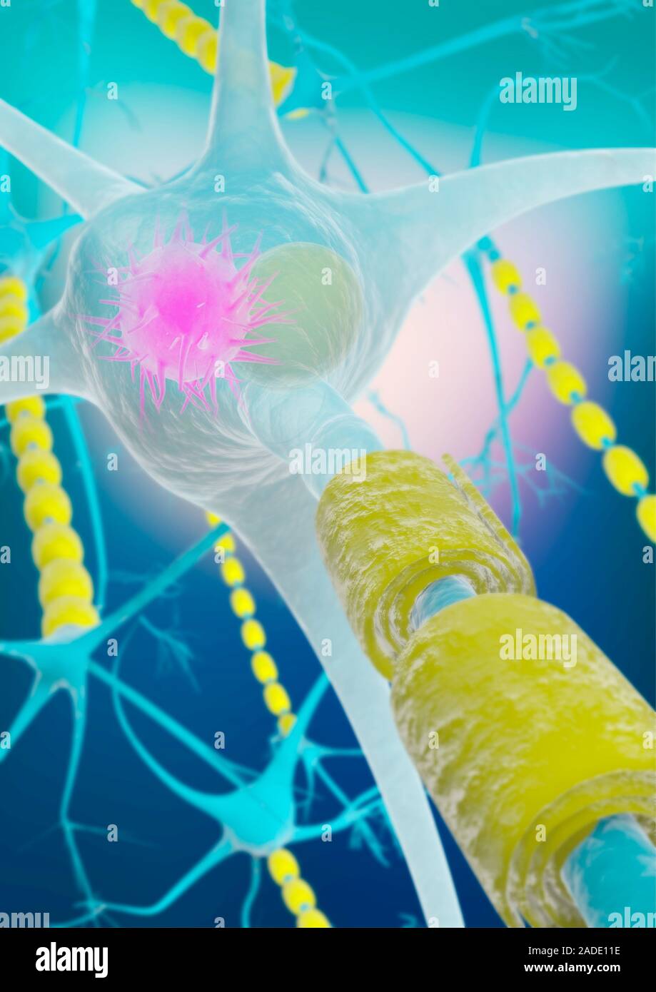 Lewy body in neuron in Parkinson's disease, illustration. Lewy bodies ...