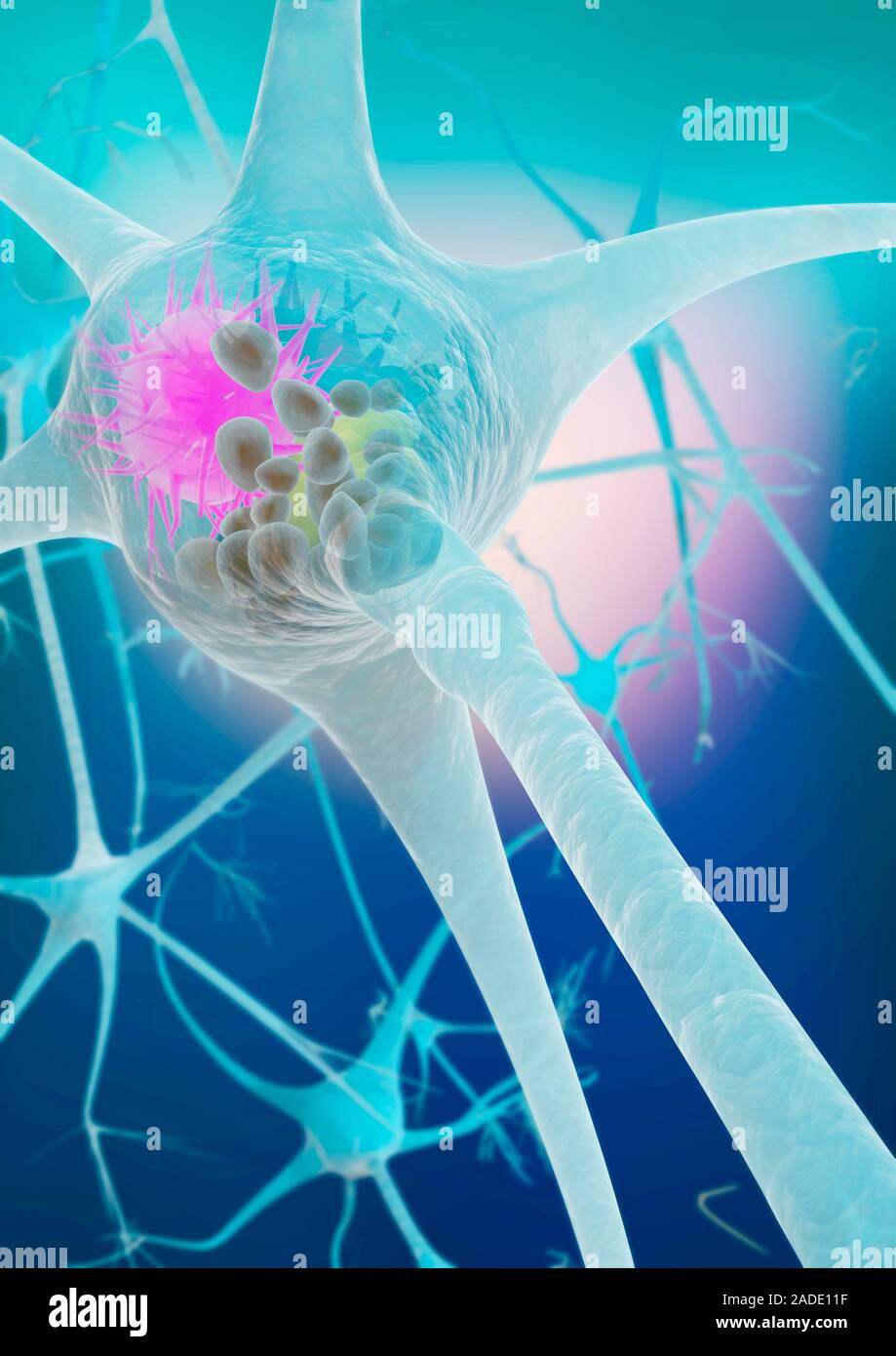 Lewy body in neuron in Parkinson's disease, illustration. Lewy bodies ...
