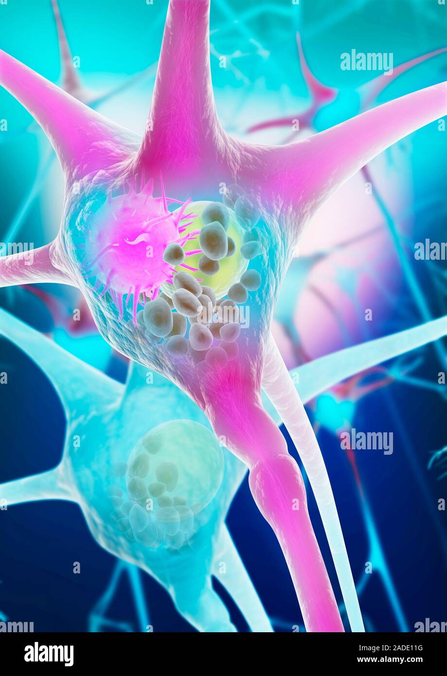 Lewy body in neuron in Parkinson's disease, illustration. Lewy bodies ...