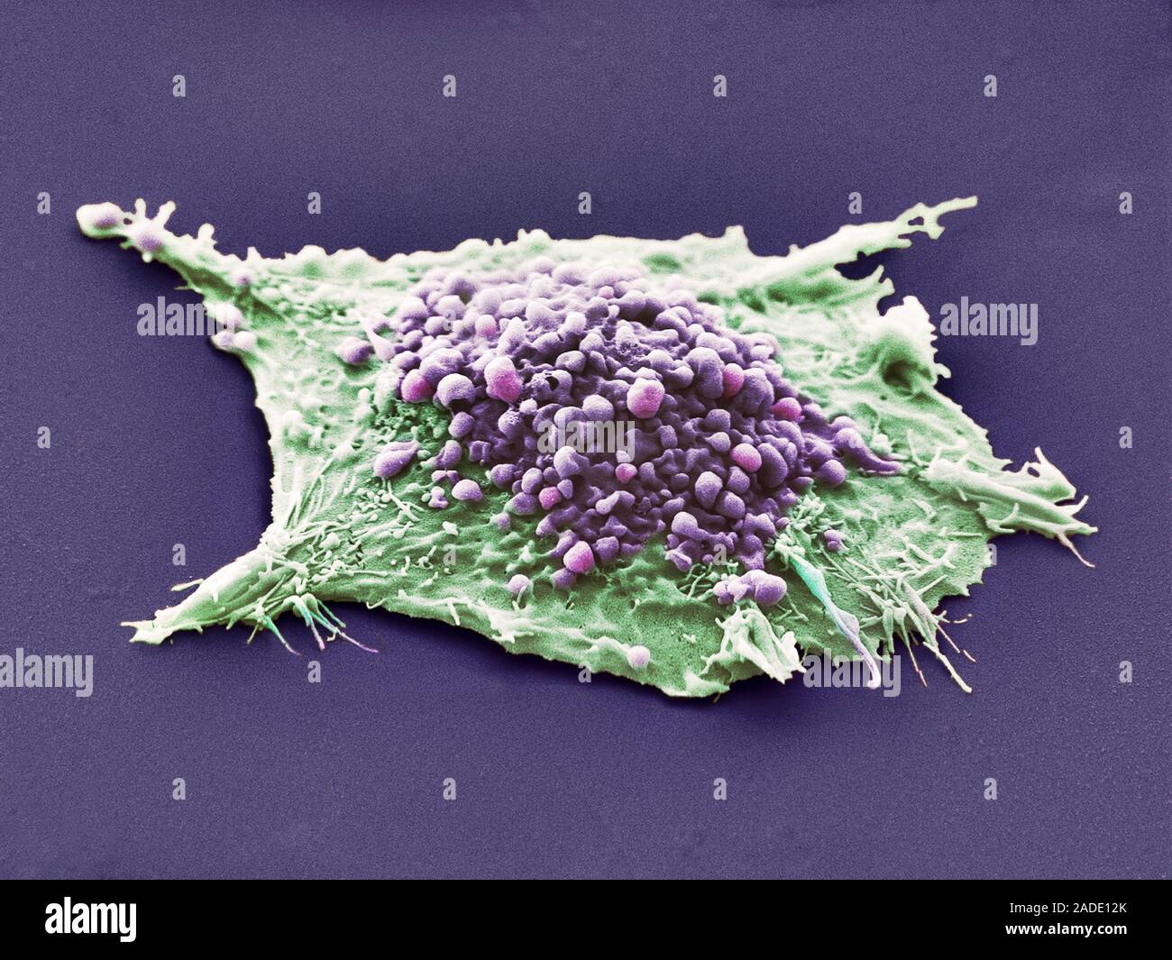 Images not to be used by the tobacco industry. Lung cancer cell with ...