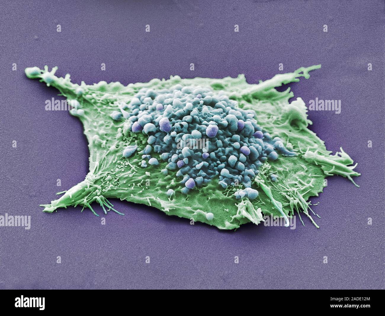 Images not to be used by the tobacco industry. Lung cancer cell with ...