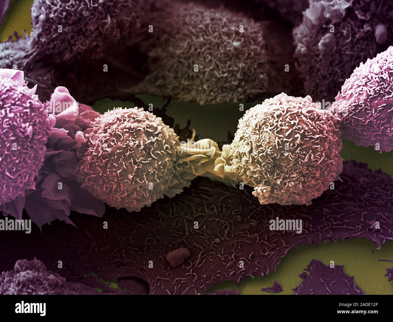 Images not to be used by the tobacco industry. Lung cancer cells ...