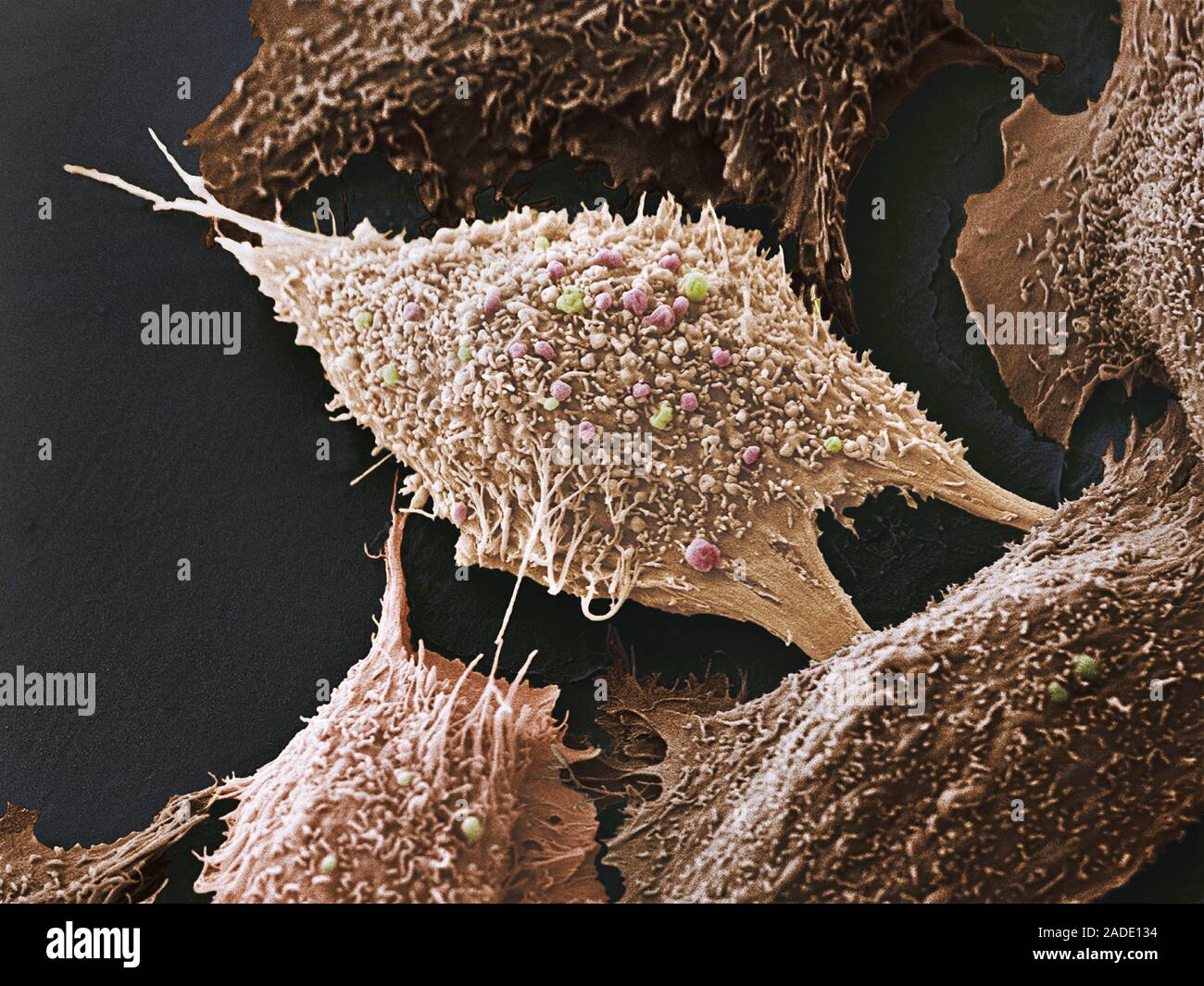 Images not to be used by the tobacco industry. Lung cancer cell with ...