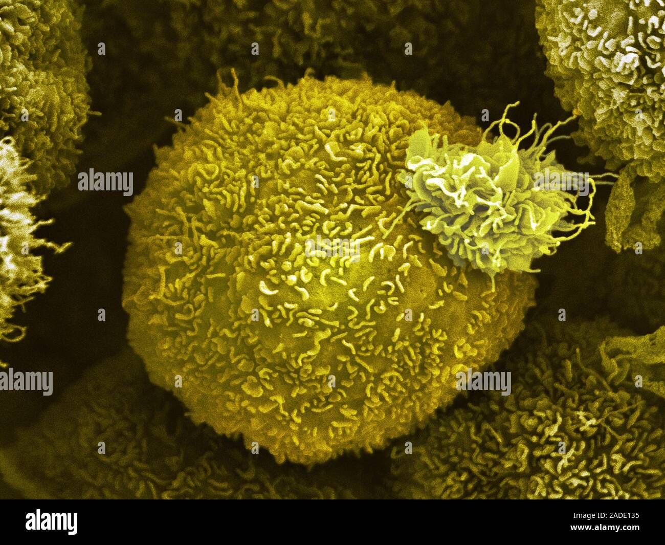 Images not to be used by the tobacco industry. Pancreatic cancer cells ...