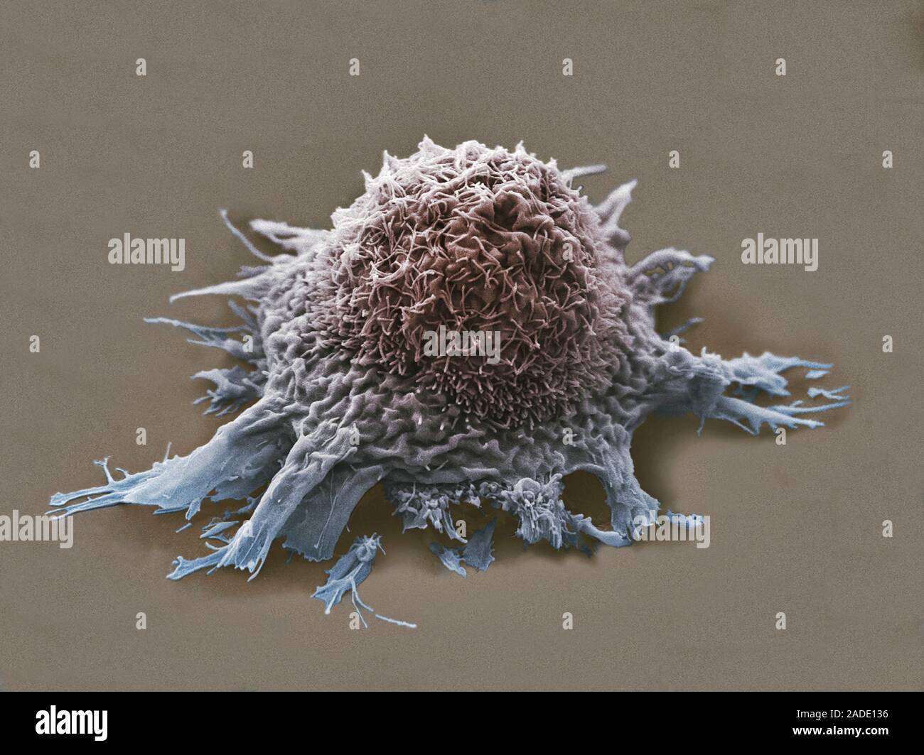 Images not to be used by the tobacco industry. Lung cancer cell ...