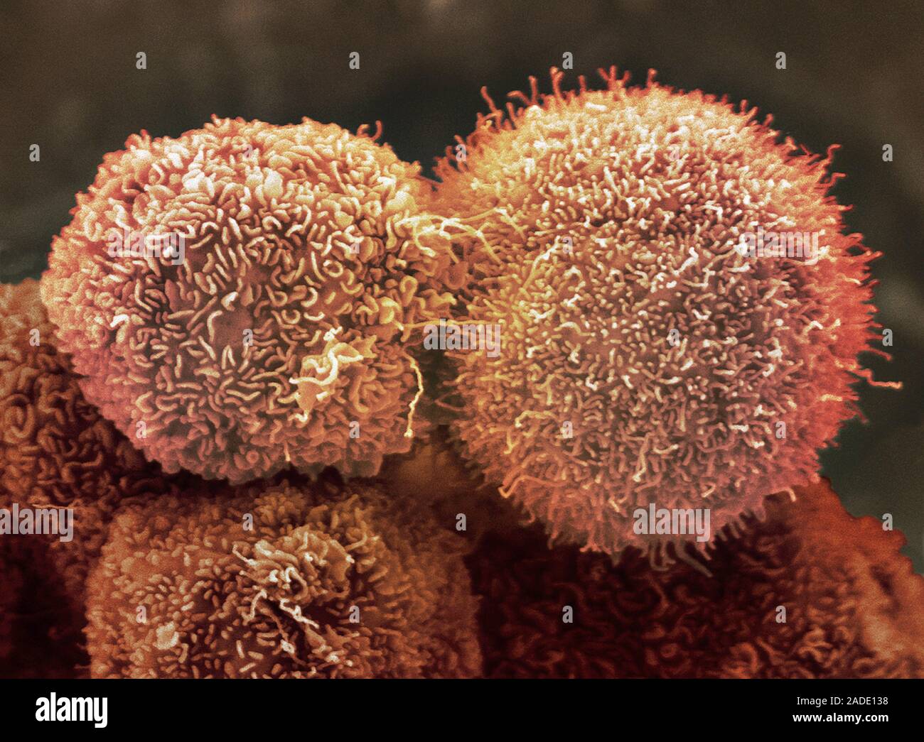 Images not to be used by the tobacco industry. Pancreatic cancer cells ...