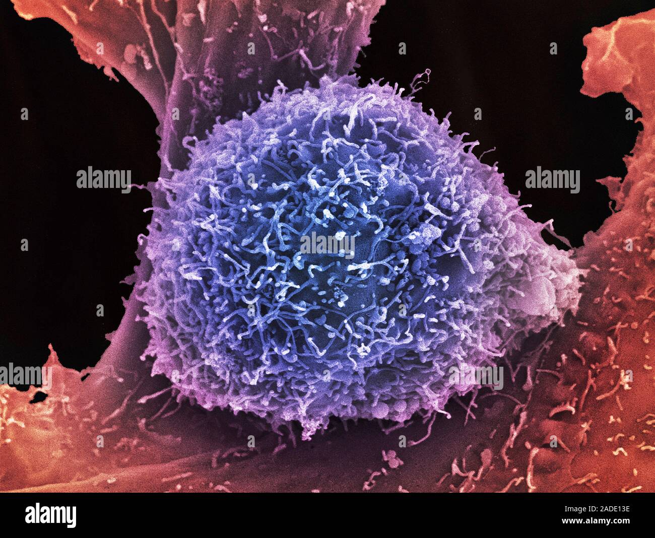 Images not to be used by the tobacco industry. Prostate cancer cells ...