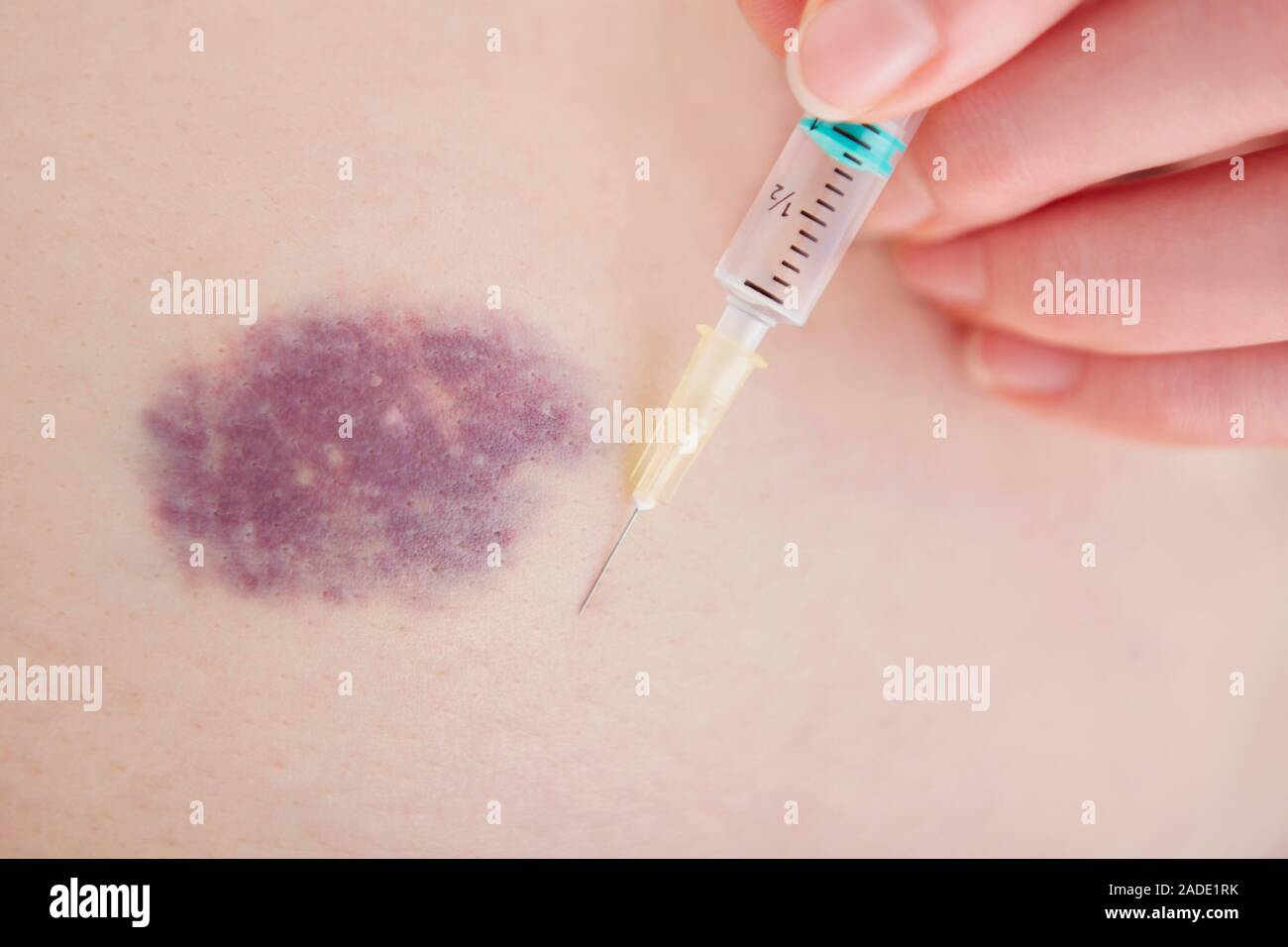 Self injection for in vitro fertilisation (IVF). Close-up of a woman ...