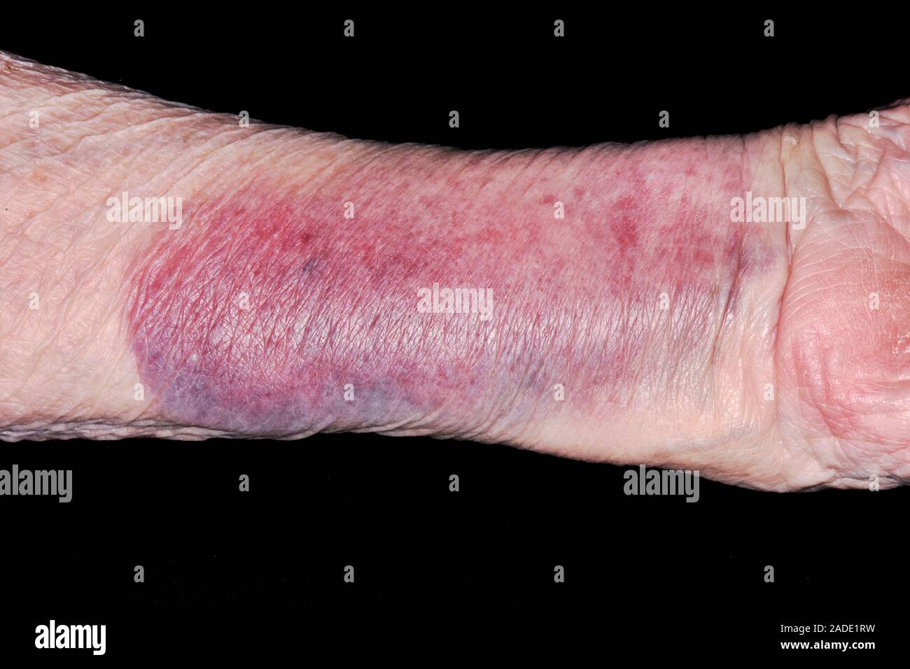 Drug-related bruising on the arm of a 91-year-old woman. At the time of ...