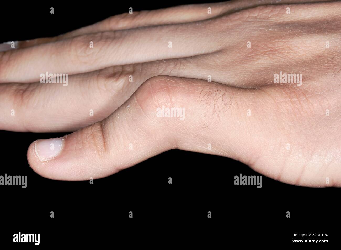 Deformity following dislocated finger. Fixed flexion deformity of the ...