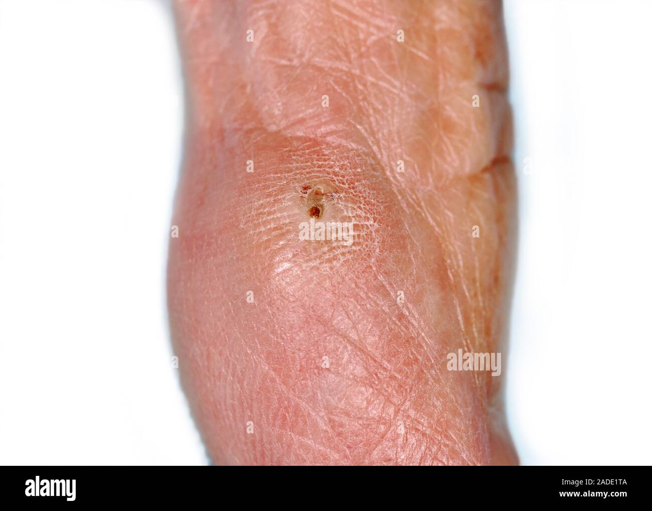 Splinter injury to the thumb of an 86-year-old woman Stock Photo - Alamy