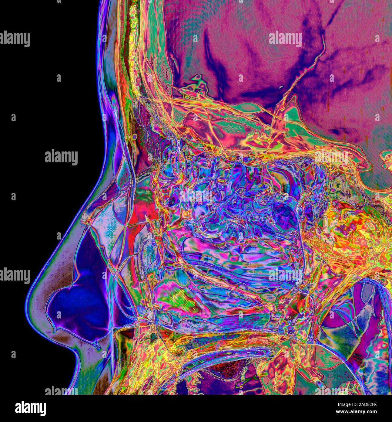 Paranasal sinuses. Coloured 3D computed tomography (CT) scan of the ...